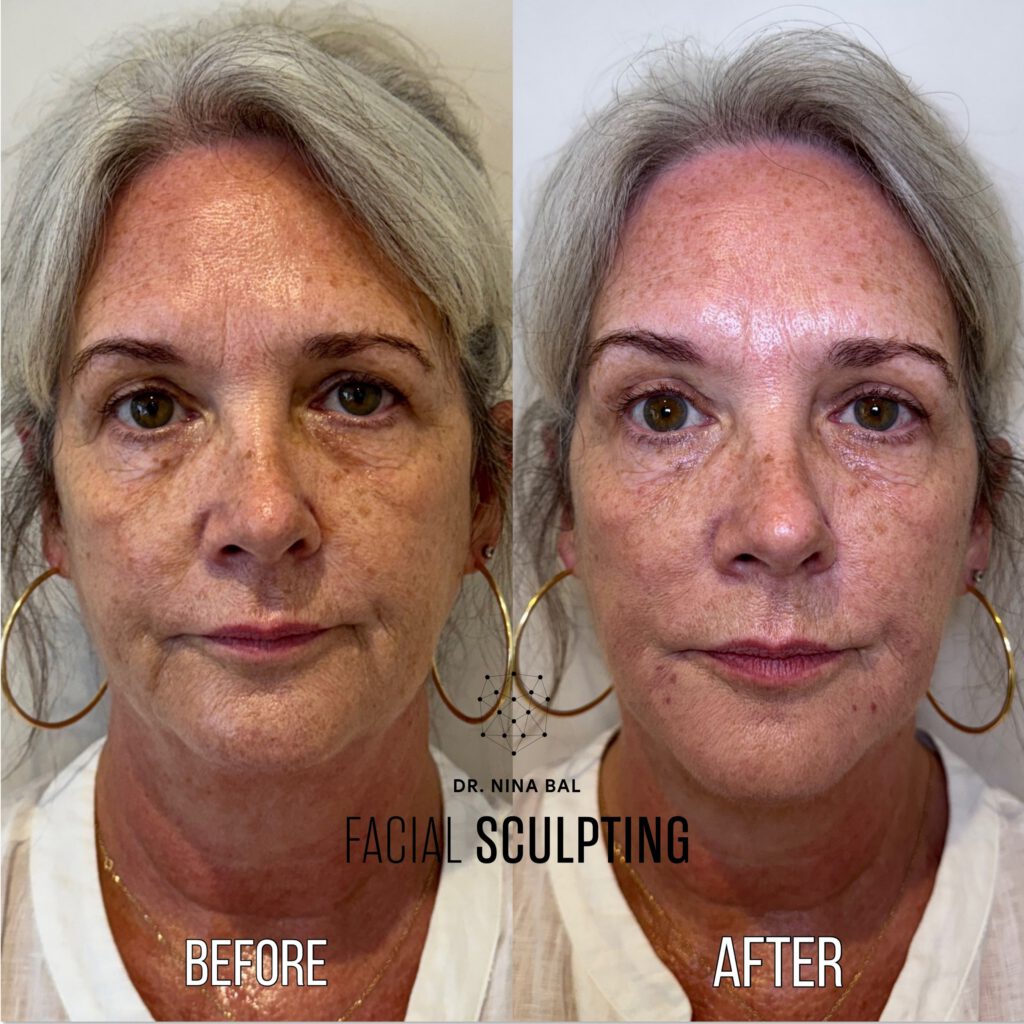 Testimonials & Results - Facial Sculpting